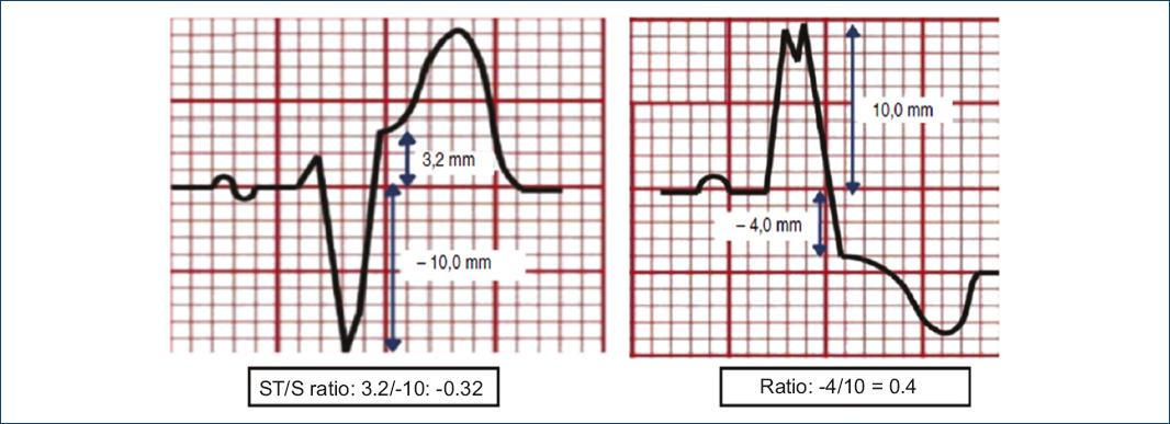 Bundle Branch Block Measurement