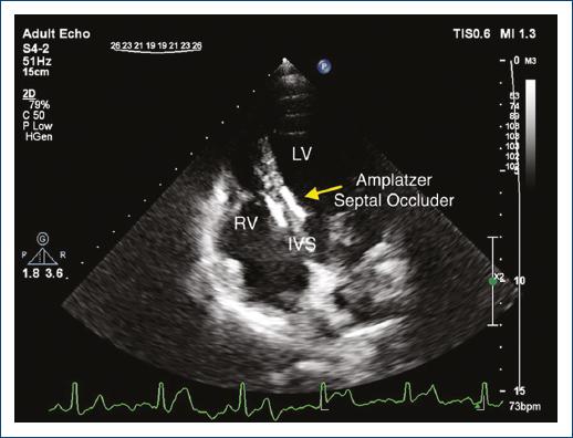 Clover-leaf artifact after successful percutaneous closure of muscular ...