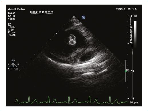 Clover-leaf artifact after successful percutaneous closure of muscular ...
