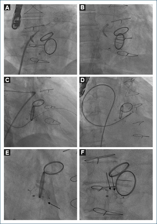 Utility of intravascular ultrasound in the diagnosis of spontaneous ...