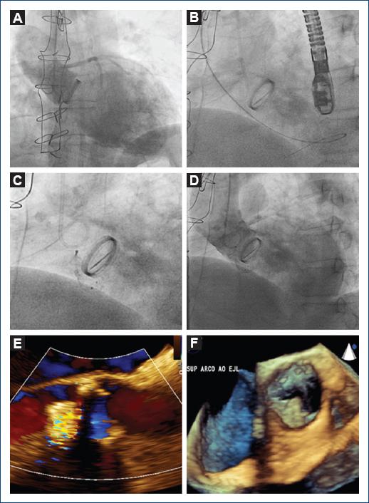 Percutaneous closure of aortic and mitral paravalvular leak with the ...