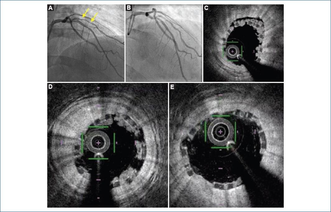 Trombosis en curso evaluada mediante tomografía de coherencia óptica