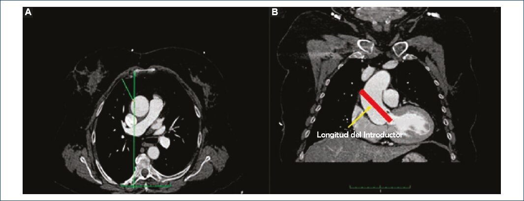 Experiencia inicial en México con la prótesis aórtica transcatéter ...