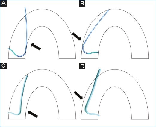 Feasibility of single catheter intervention for multivessel coronary ...