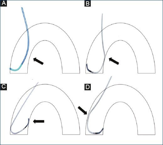 Feasibility of single catheter intervention for multivessel coronary ...