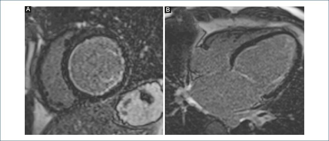 Young male with long-term impaired ejection fraction - endocardial ...