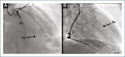 Choque cardiogénico poscirugía de revascularización de miocardio debido ...