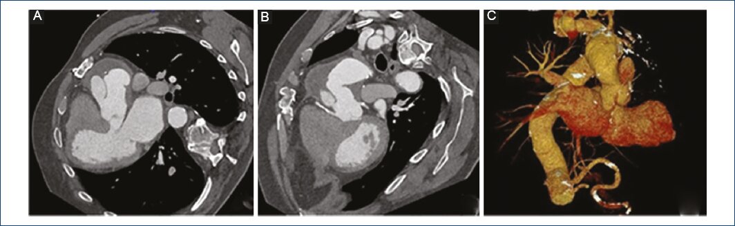 Aortic pseudoaneurysm as a casual finding 4 years after aortic surgery