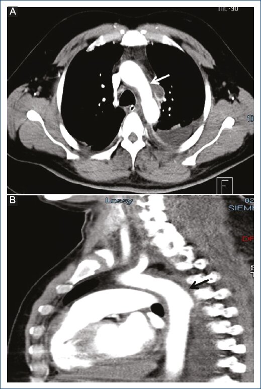 Sección traumática completa del istmo aórtico: Tratamiento tardío con ...
