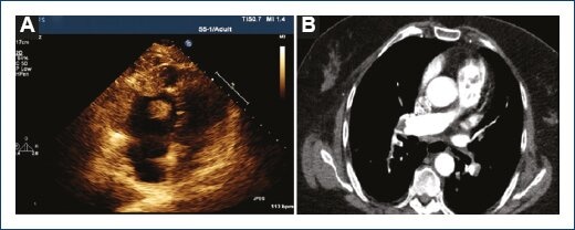 Cardiac metastasis from liposarcoma to the right ventricle complicated ...