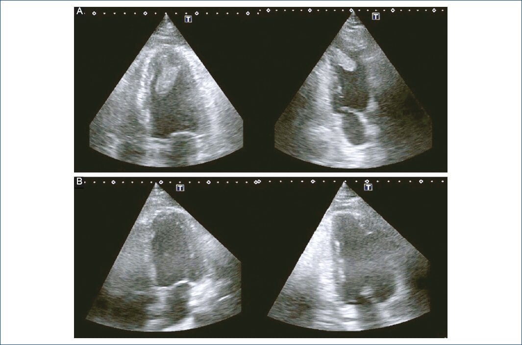 Un trombo ventricular de origen desconocido