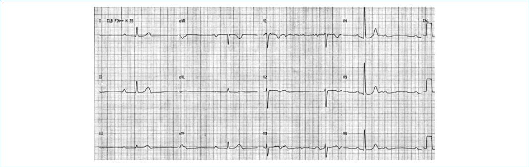 Unusual ventricular activation produced by temporary transvenous ...
