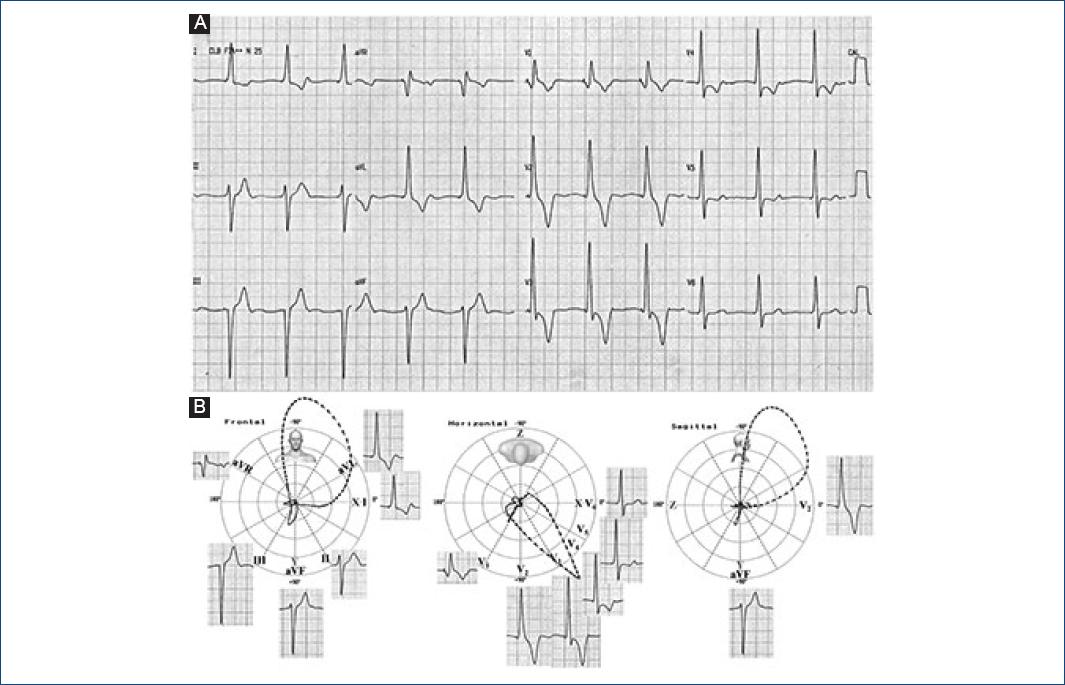 Unusual ventricular activation produced by temporary transvenous ...