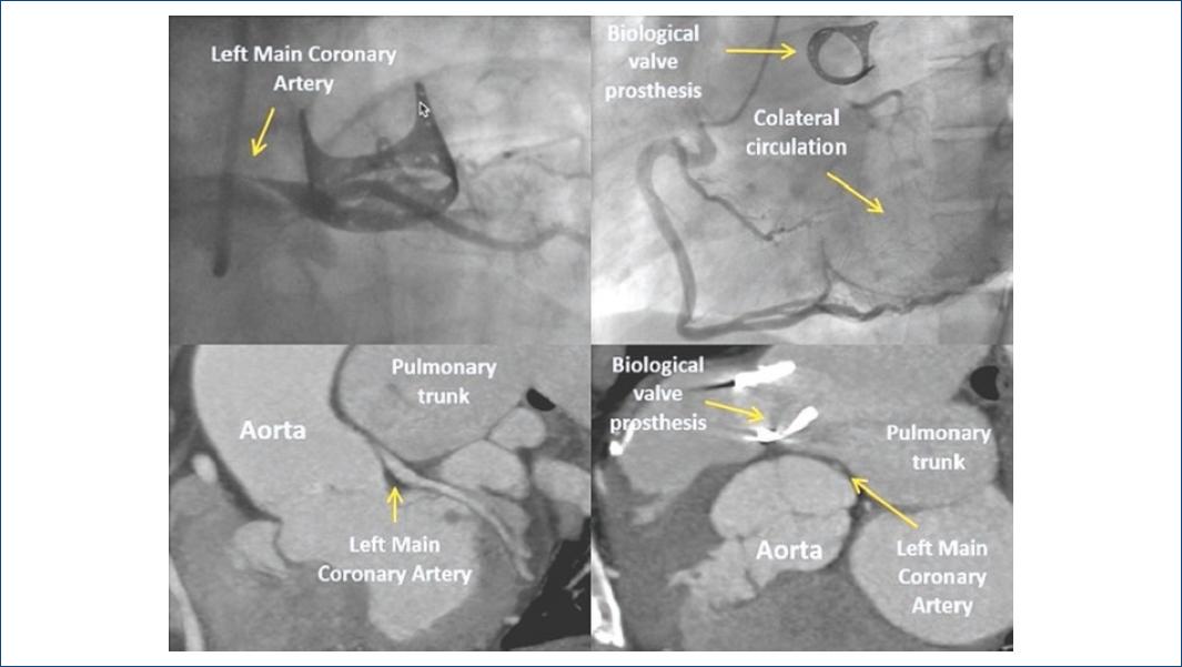 Left main coronary artery compression by the right pulmonary artery in ...