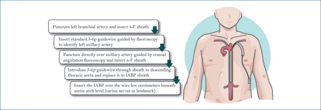 Percutaneous placement of intra-aortic balloon pump in the left ...