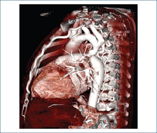 Efectos de la impresión 3D en la planificación quirúrgica de las ...