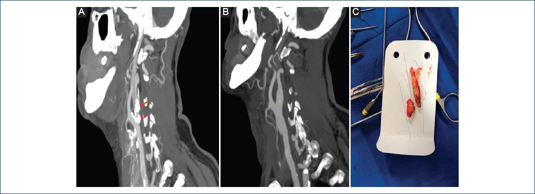Carotid endarterectomy for severe symptomatic carotid stenosis