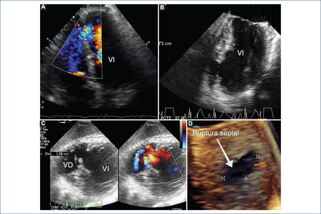 Ruptura septal de localización atípica posterior a infarto del ...