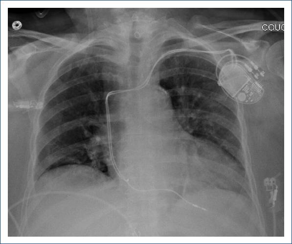 Imágenes de la manipulación externa de un marcapasos por parte del paciente