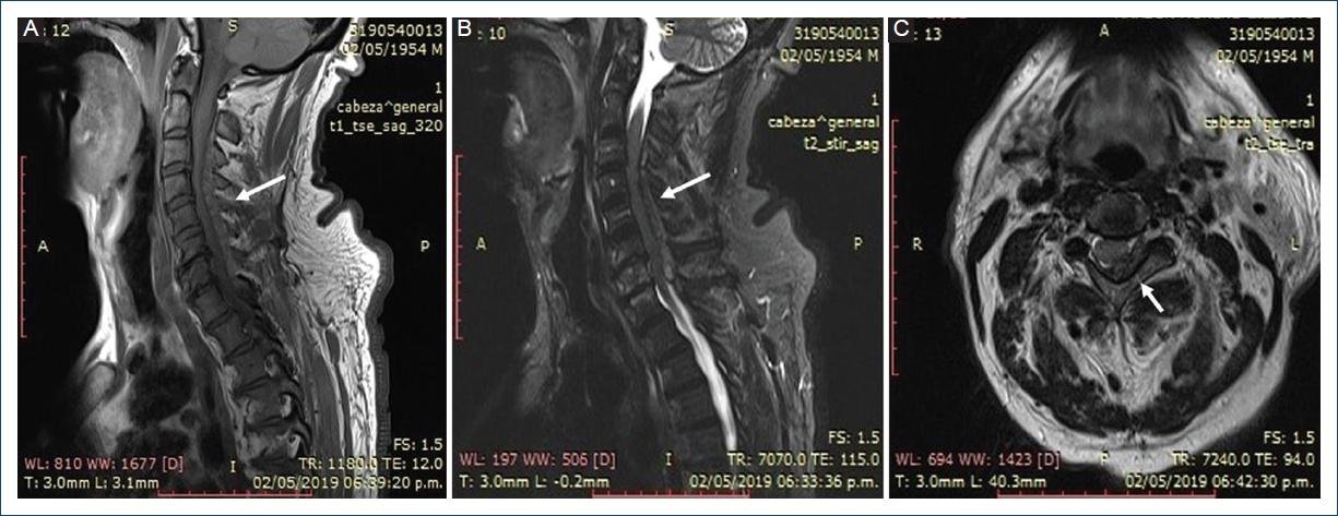 Hematoma epidural medular como complicación de trombólisis en un ...