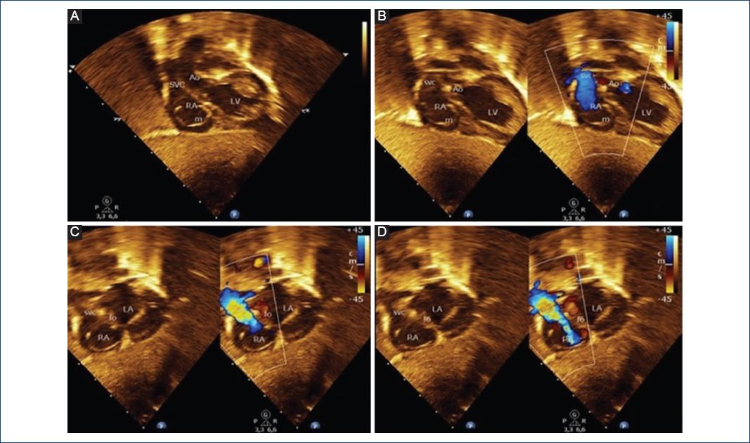 Cor Triatriatum Dexter: an unusual cause of neonatal cyanosis