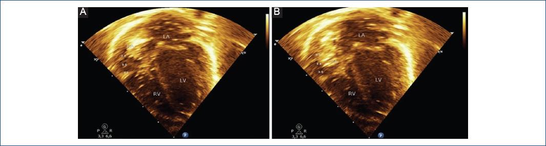 Cor Triatriatum Dexter: an unusual cause of neonatal cyanosis
