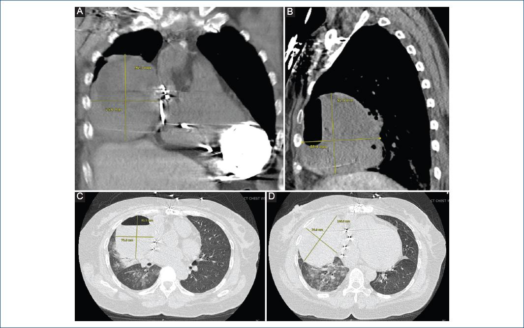 Ruptured hemorrhagic bulla in a patient with a HeartMate 3 treated with ...