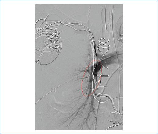 Ruptured hemorrhagic bulla in a patient with a HeartMate 3 treated with ...