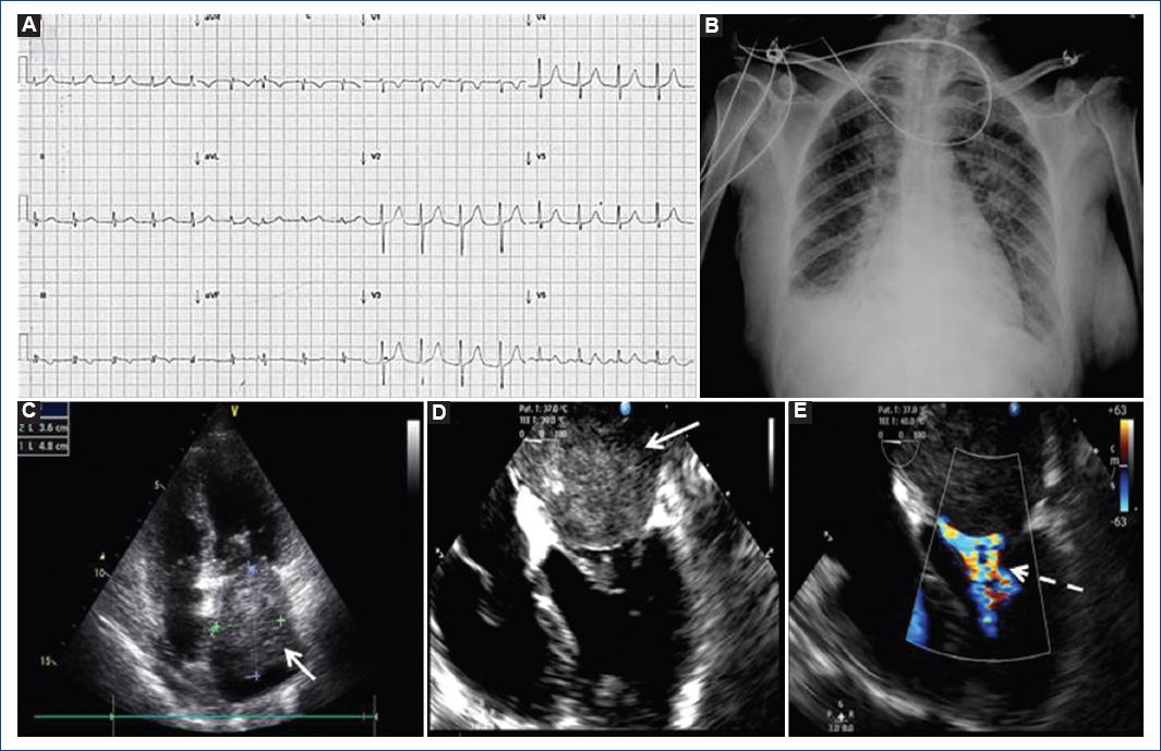High-grade undifferentiated pleomorphic cardiac sarcoma: A rare ...