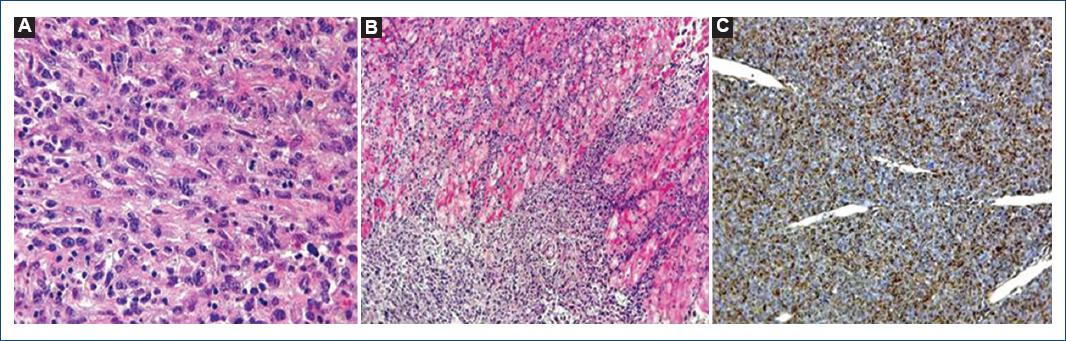 High-grade undifferentiated pleomorphic cardiac sarcoma: A rare ...