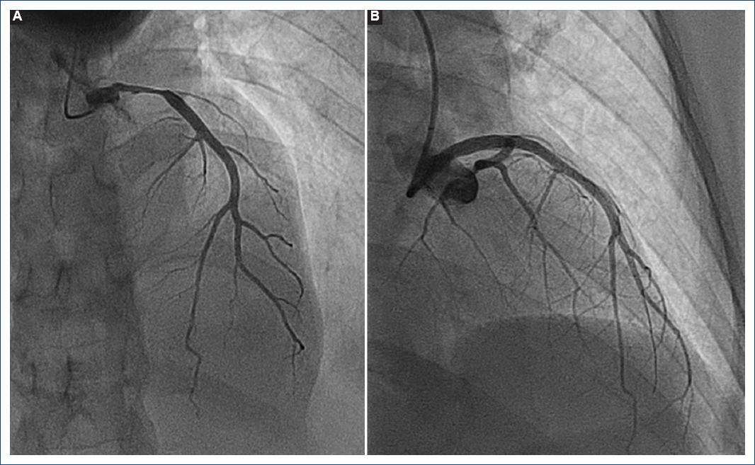 Disección coronaria espontánea: ¿revascularización o manejo conservador?
