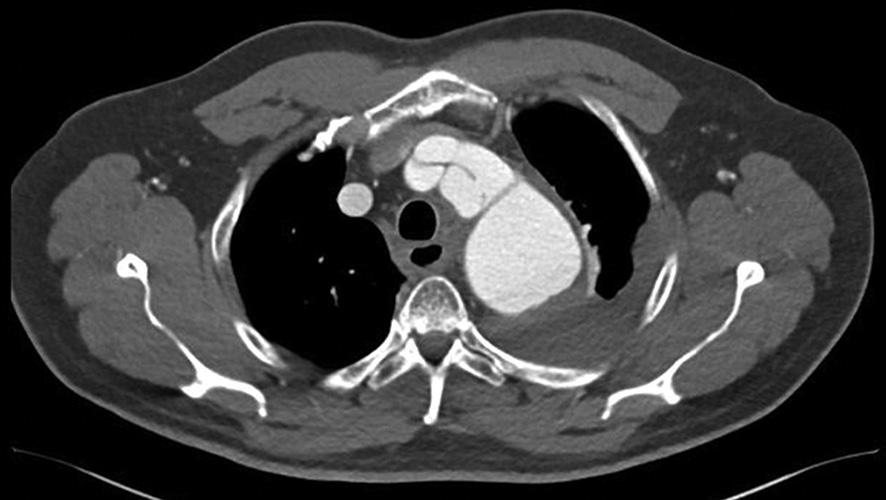 Disección aórtica posterior a cirugía de Bentall y de Bono