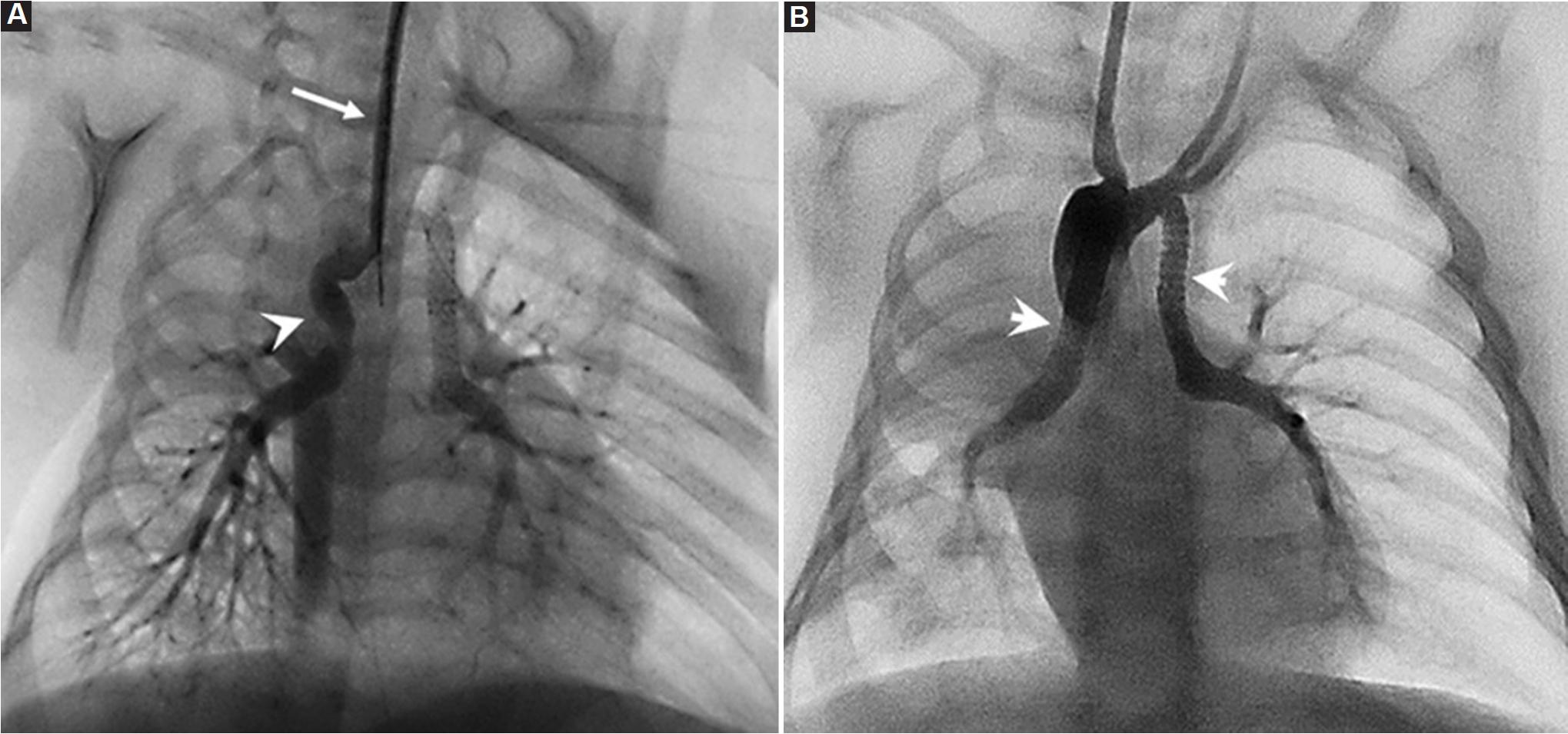Stent ductal bilateral en un neonato andino con arterias pulmonares ...