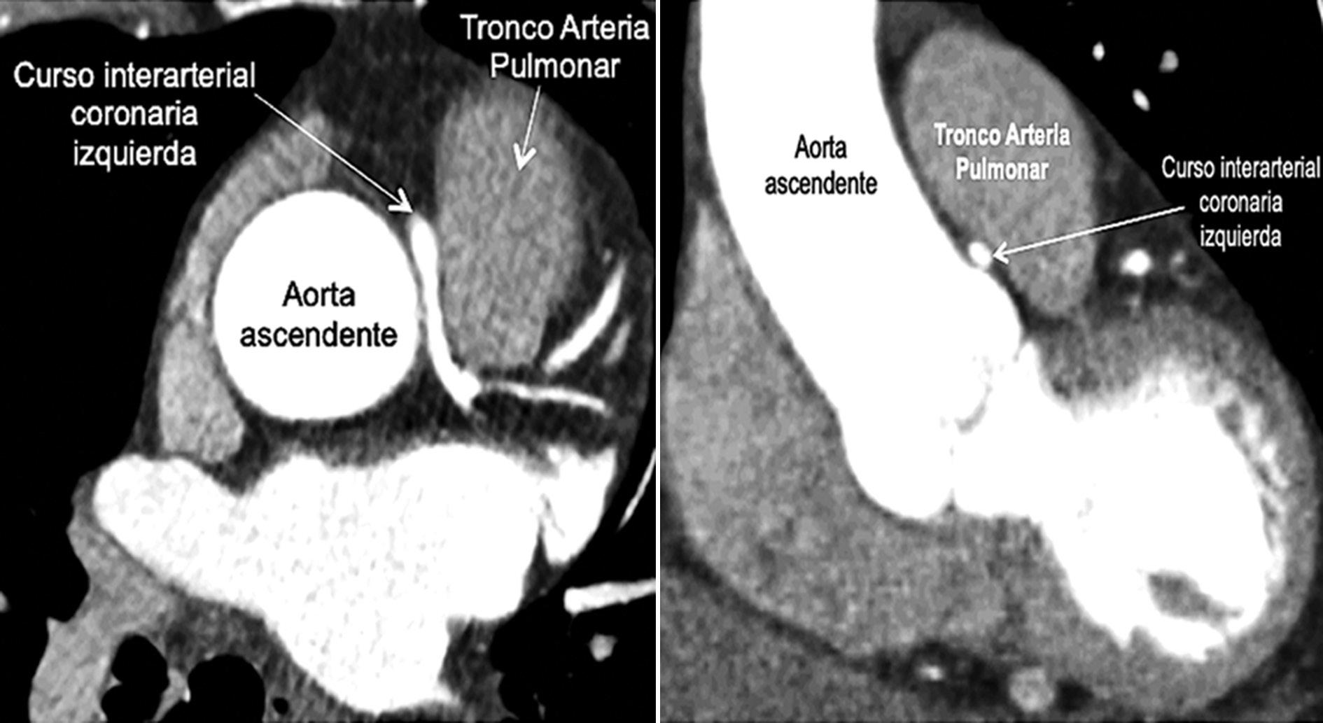 Origen «maligno» de arteria coronaria izquierda, reporte de caso