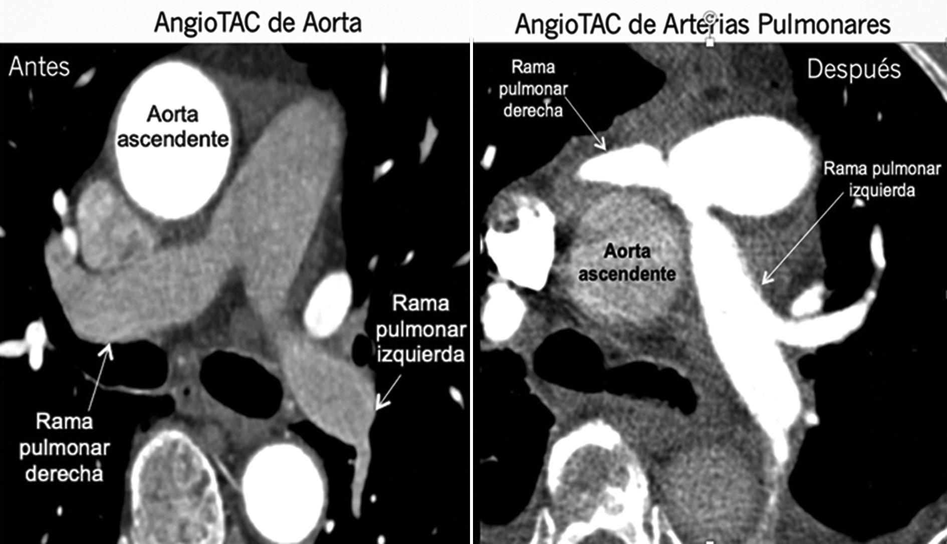 Origen «maligno» de arteria coronaria izquierda, reporte de caso