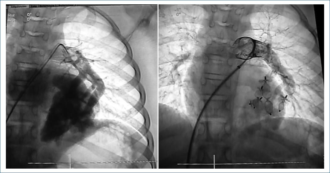 Percutaneous occlusion of five pulmonary arteriovenous fistulas in the ...