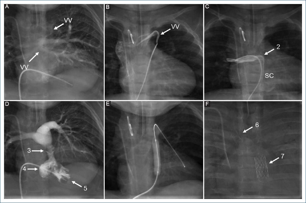 ¿Existe conexión anómala total de venas pulmonares con ventrículo ...