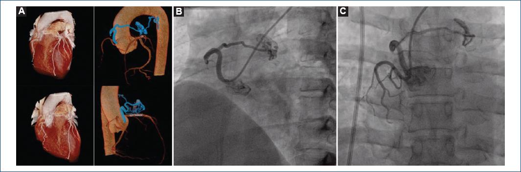 Vieussens’ ring fistula to pulmonary artery: embolization with ...