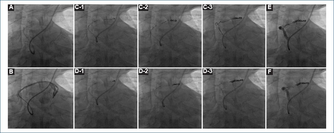 Vieussens’ ring fistula to pulmonary artery: embolization with ...