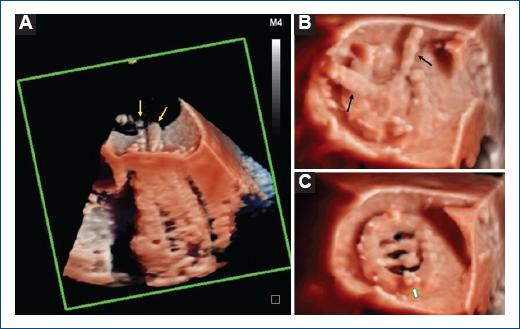 El impacto de la ecocardiografía transesofágica tridimensional con ...