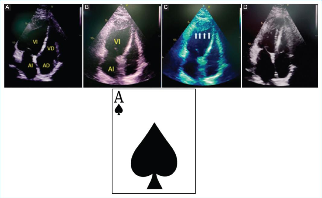 As de picas y miocardiopatía hipertrófica apical: un signo para no olvidar