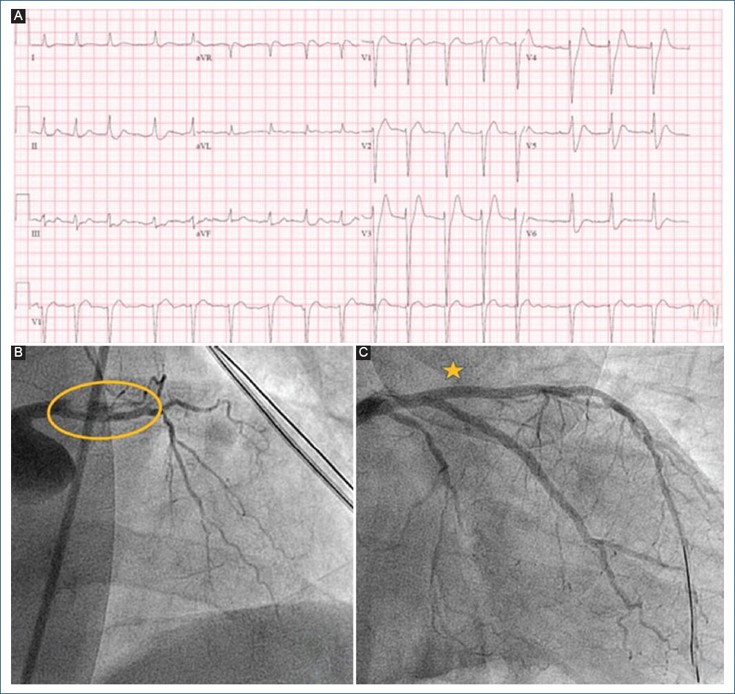 Patrones electrocardiográficos «Wellens» y «de Winter» como ...