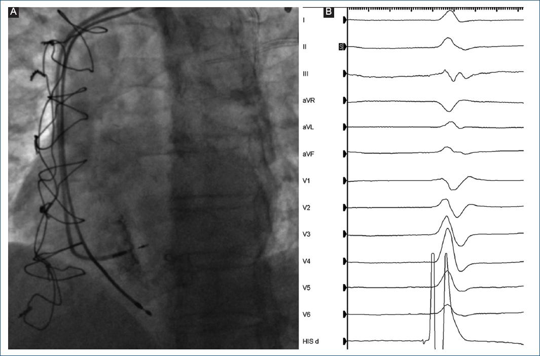 Mejoría clínica, hemodinámica y de marcadores bioquímicos tras ...