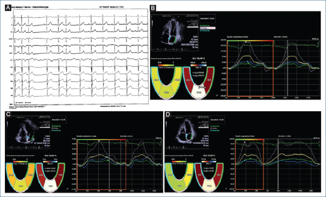 Assessment of short forms of recurrent atrial extra systoles by ...