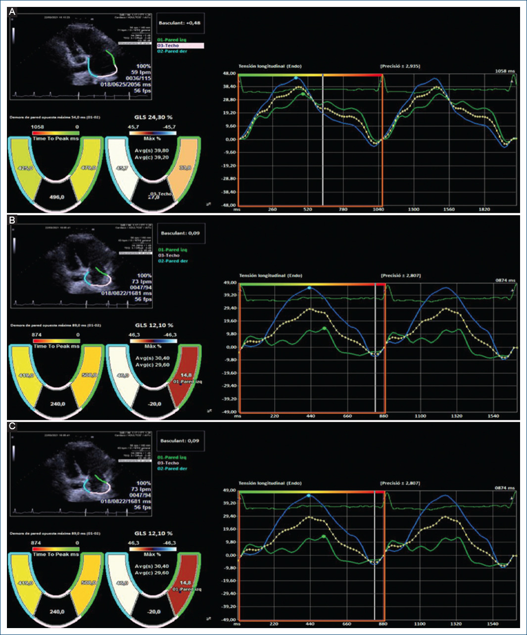 Assessment of short forms of recurrent atrial extra systoles by ...