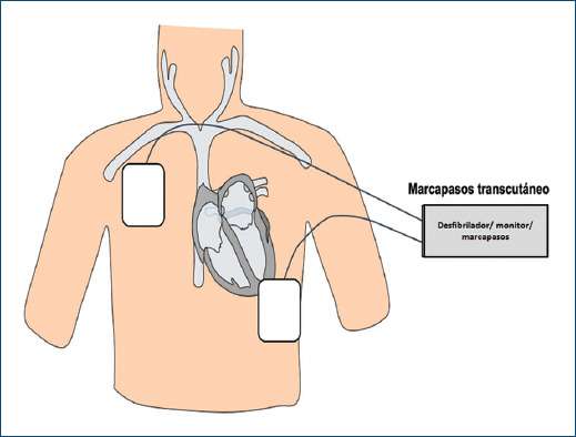 Guía para identificar características específicas en dispositivos de estimulación cardiaca ...