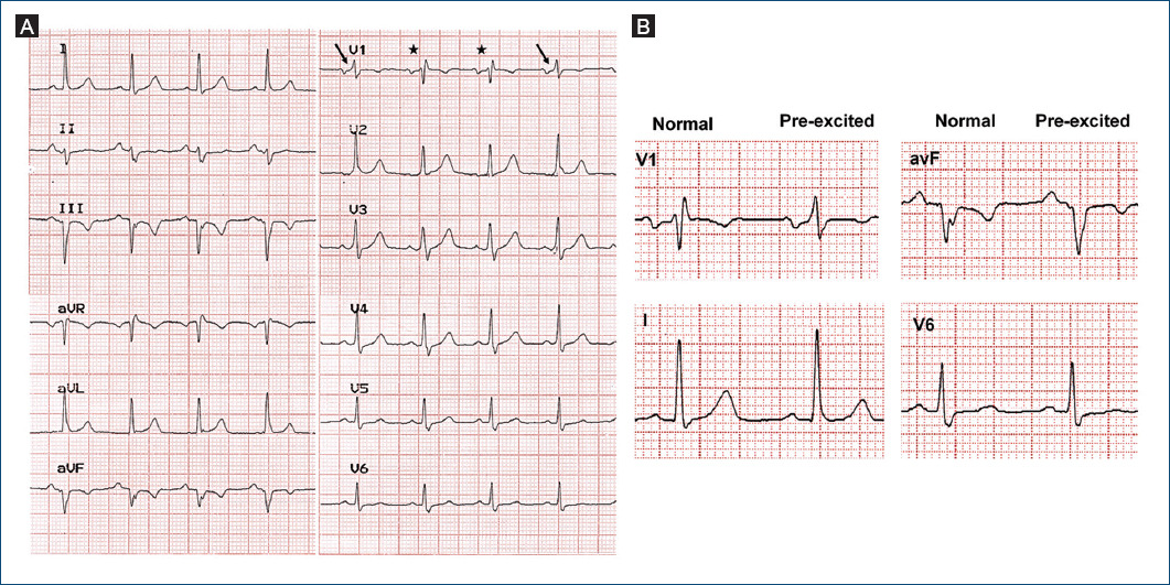Alternating right bundle branch block or intermittent preexcitation?