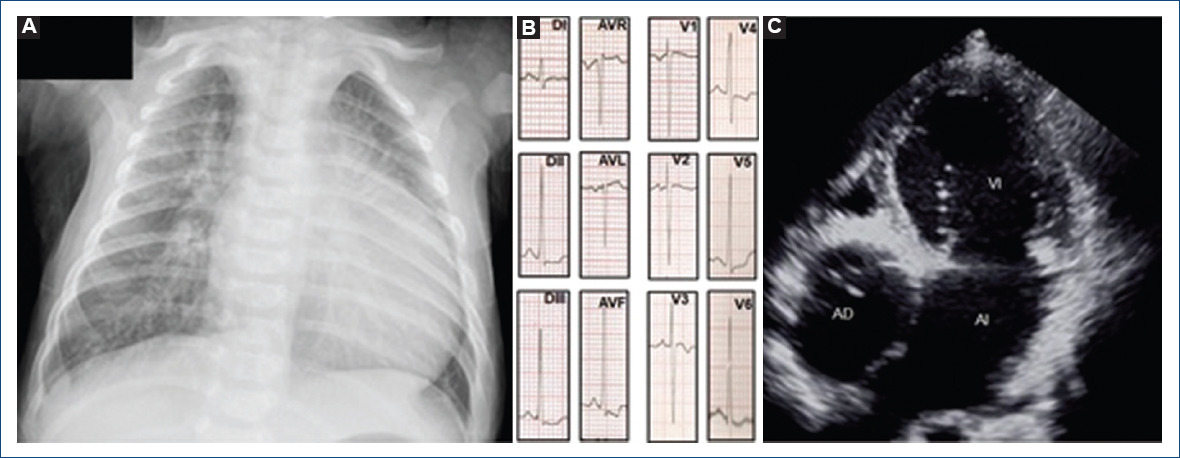 Damus-Kaye-Stansel surgery in a patient with tricuspid atresia ...