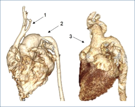 Damus-Kaye-Stansel surgery in a patient with tricuspid atresia ...