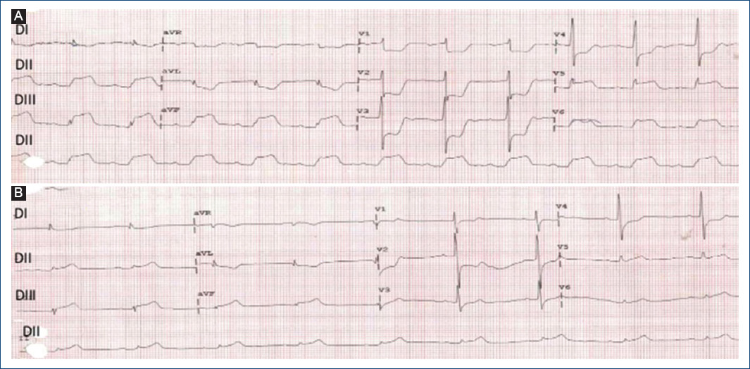 Anomalía Del Origen De Las Arterias Coronarias Puede Llevar A Un